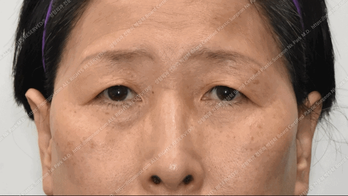 3 Types Of Eyelid Lift To Rejuvenate Hooded Eyes » Noonopi Plastic ...
