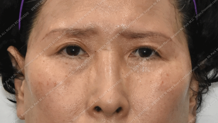 3 Types Of Eyelid Lift To Rejuvenate Hooded Eyes » Korean Plastic Surgery2
