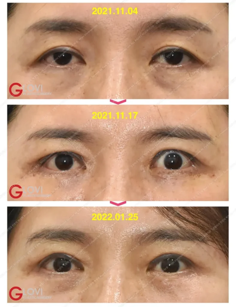 A Complete Guide To Ptosis Surgery: Treating Droopy Eyelids » Noonopi ...
