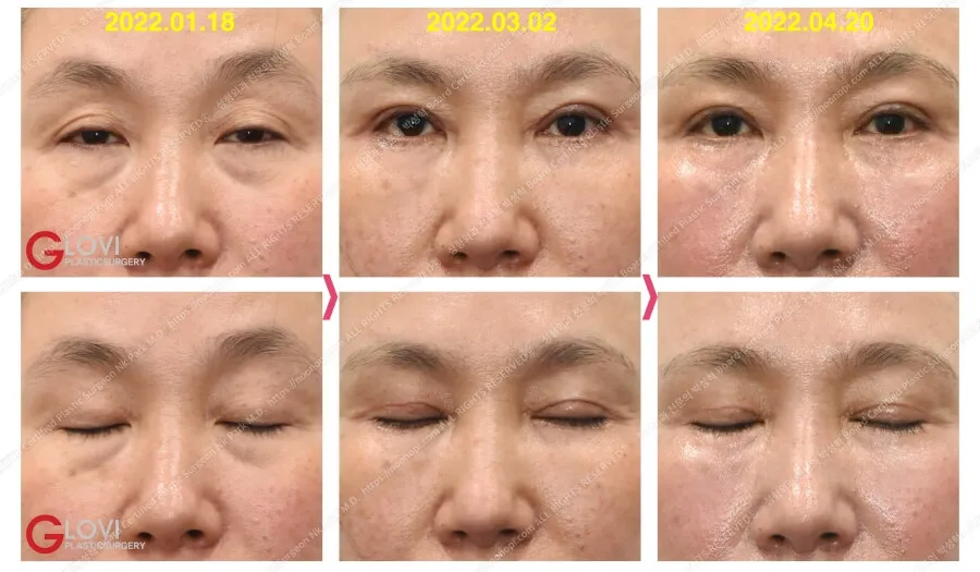 A Complete Guide To Ptosis Surgery: Treating Droopy Eyelids » Noonopi ...
