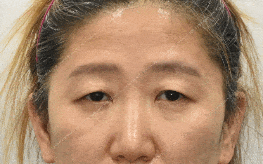 3 Types Of Eyelid Lift To Rejuvenate Hooded Eyes » Noonopi Plastic ...
