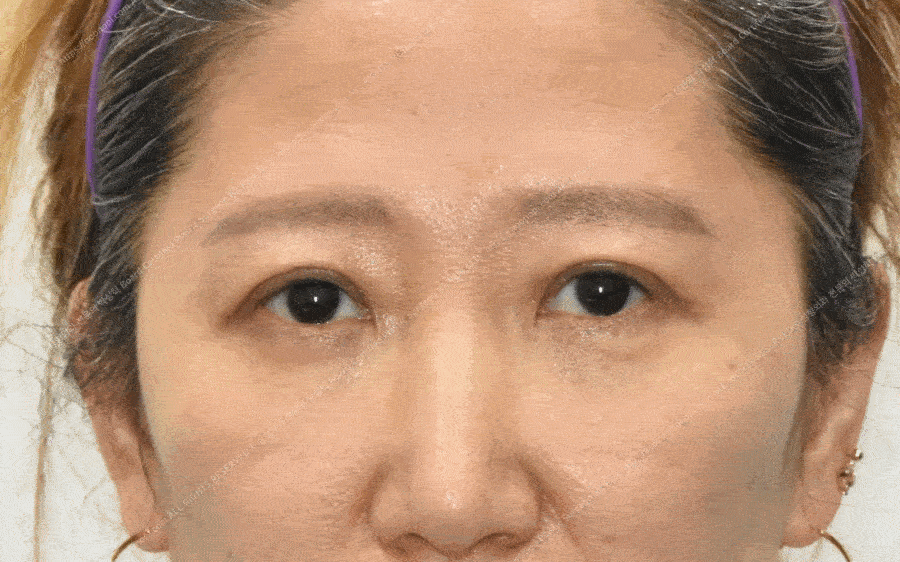 3 Types Of Eyelid Lift To Rejuvenate Hooded Eyes » Noonopi Plastic ...