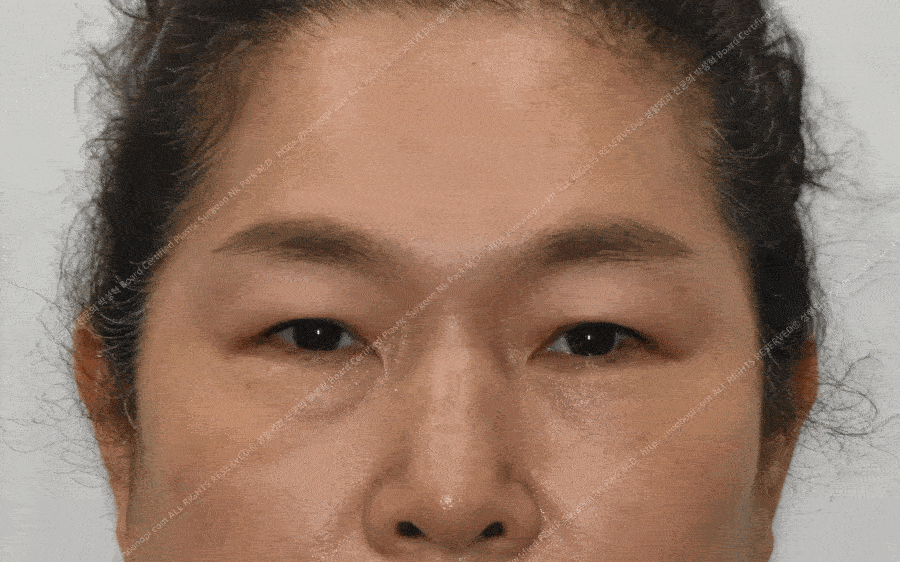 3 Types Of Eyelid Lift To Rejuvenate Hooded Eyes » Noonopi Plastic ...