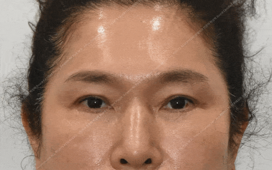 3 Types Of Eyelid Lift To Rejuvenate Hooded Eyes » Noonopi Plastic ...