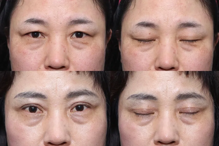 3 Types Of Eyelid Lift To Rejuvenate Hooded Eyes » Noonopi Plastic ...
