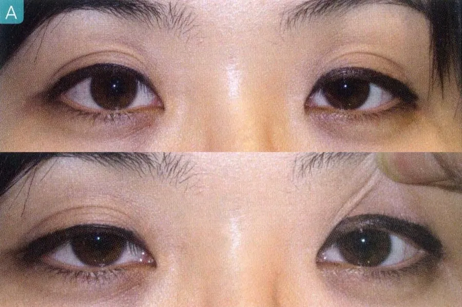 A Complete Guide To Ptosis Surgery: Treating Droopy Eyelids » Noonopi ...