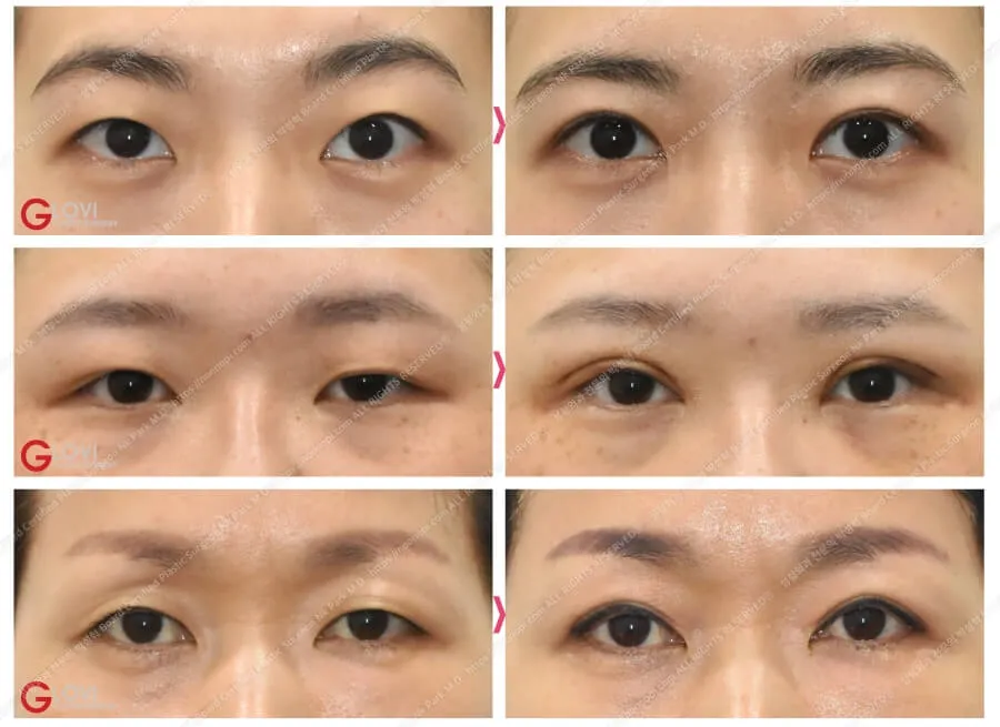A Complete Guide To Ptosis Surgery: Treating Droopy Eyelids » Noonopi ...