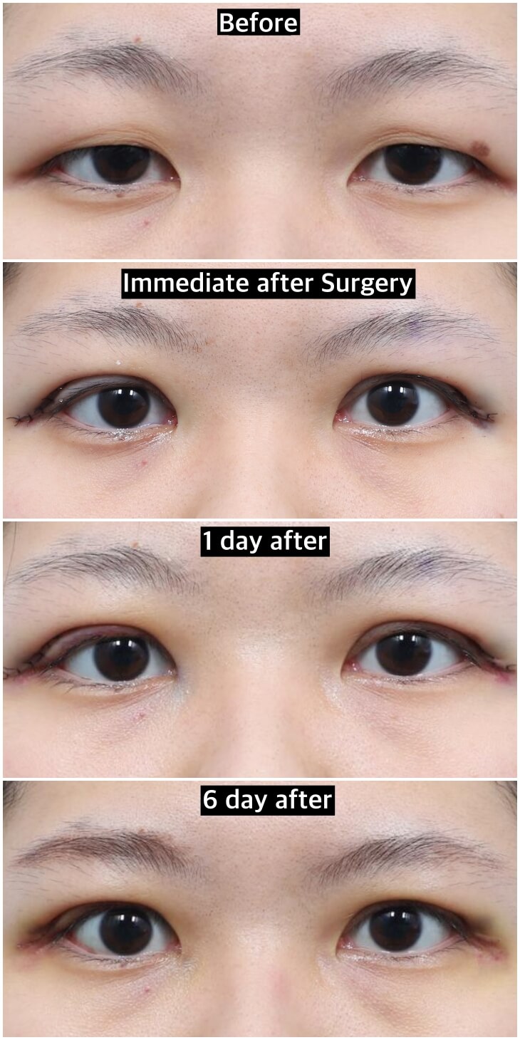 Comparing Surgical Method In Double Eyelid Surgery Korea » Noonopi ...