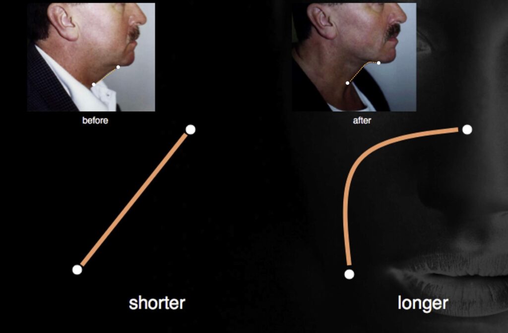 3 Reasons Why You Should Get A Facelift And Neck Lift Together ...