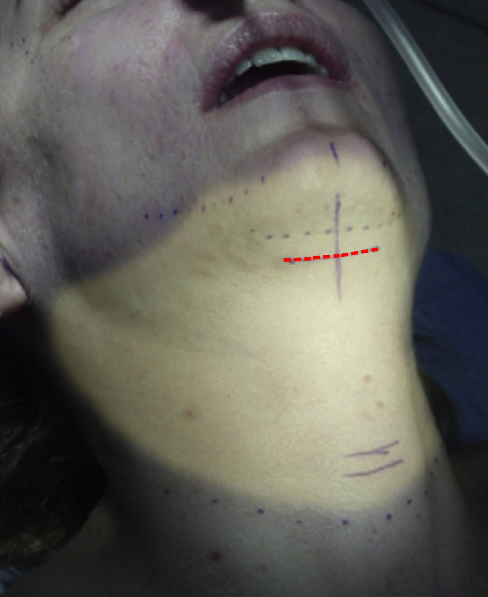 3 Reasons Why You Should Get A Facelift And Neck Lift Together ...