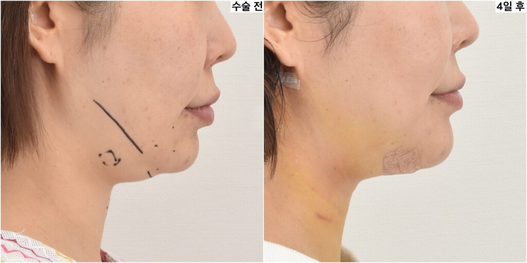 3 Reasons Why You Should Get A Facelift And Neck Lift Together ...