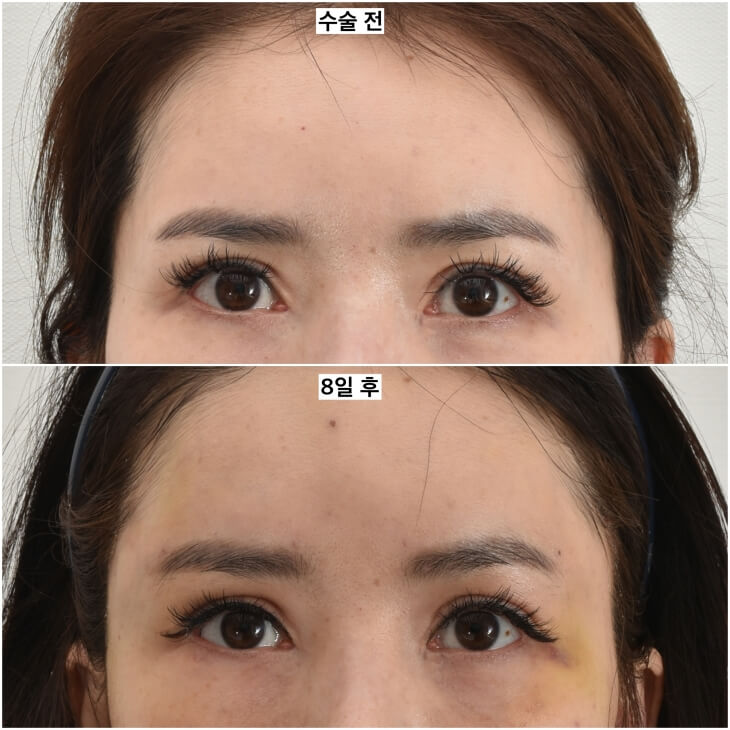 Facial Fat Grafting : Noonopi Plastic Surgery Korea » Noonopi Plastic ...