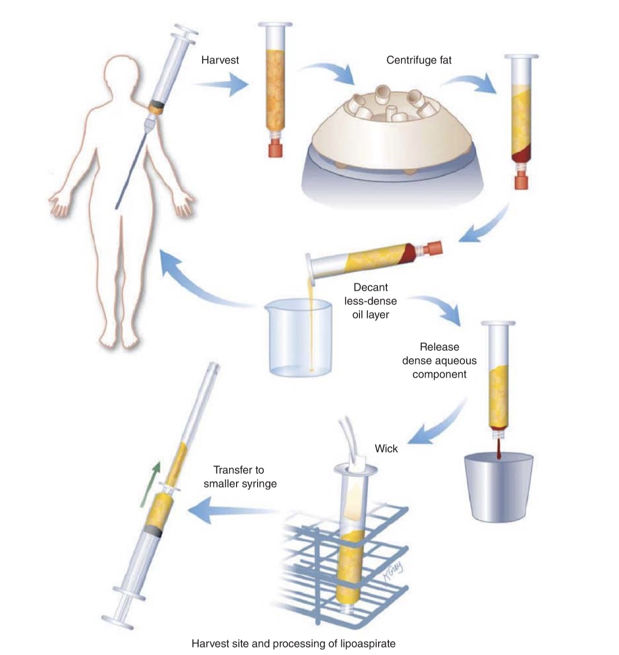 Facial Fat Grafting : Noonopi Plastic Surgery Korea » Noonopi Plastic ...