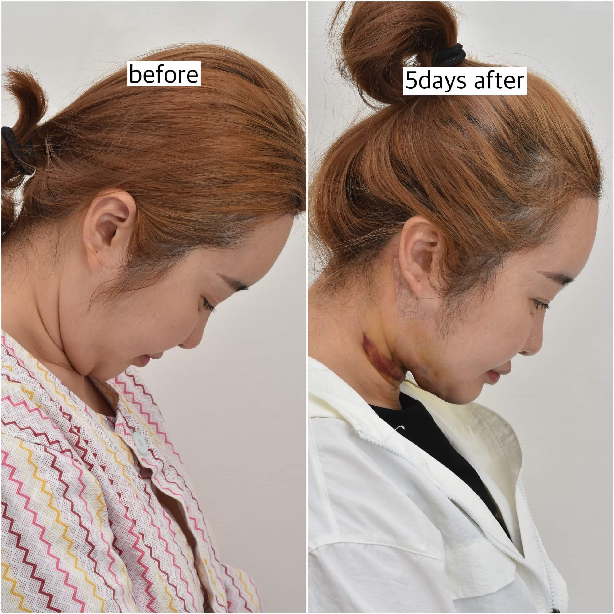Neck Lift: Solutions For Turkey Neck And Double Chin » Noonopi Plastic ...