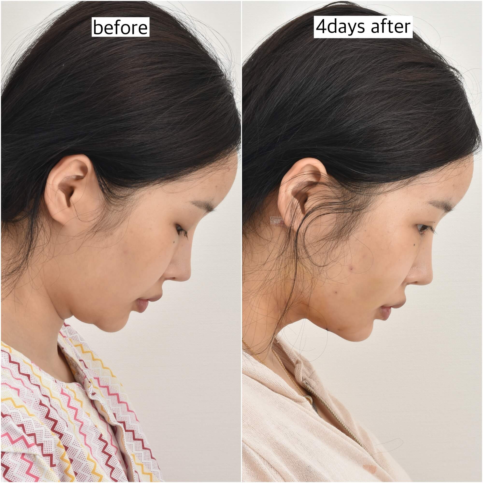 Neck Lift: Solutions For Turkey Neck And Double Chin » Noonopi Plastic ...
