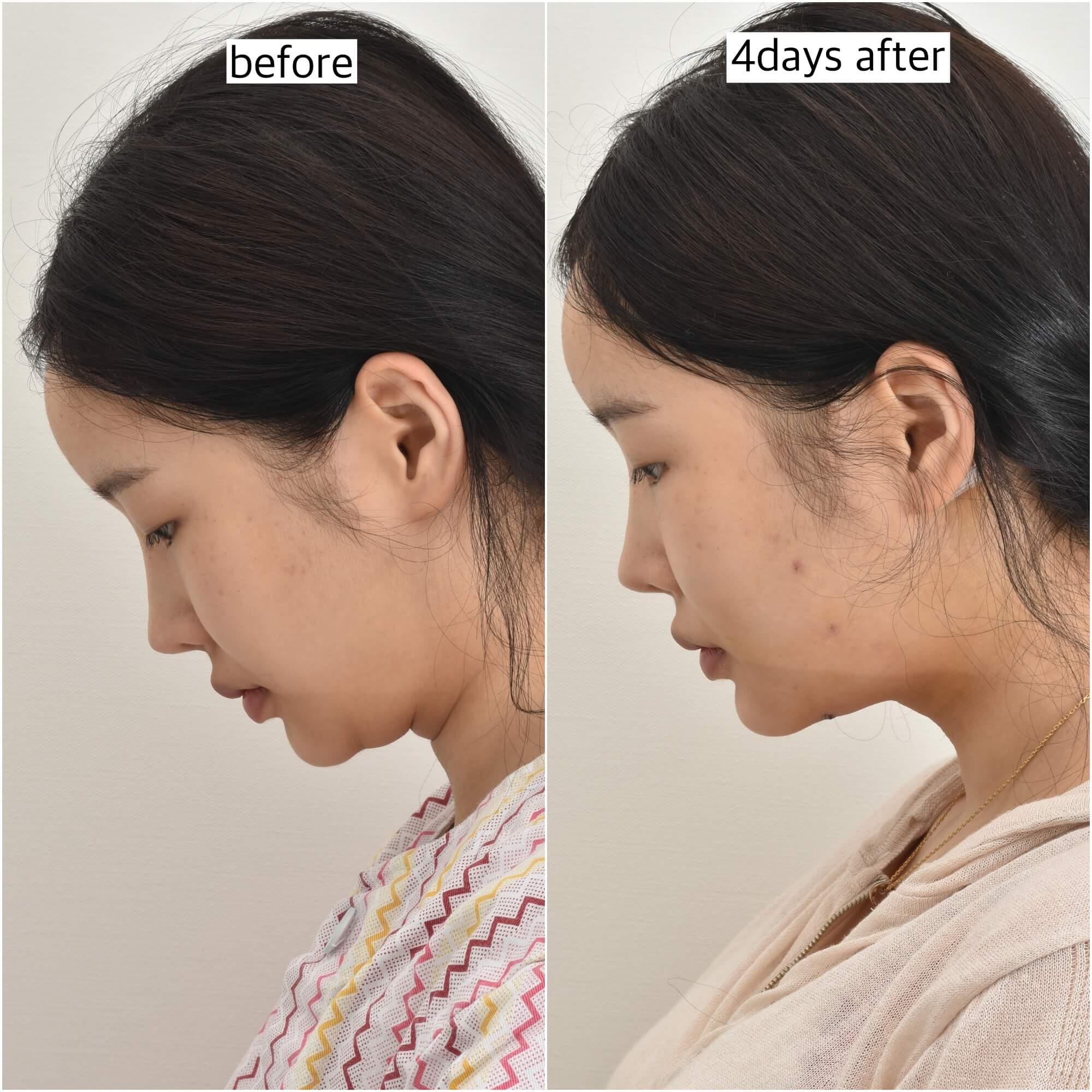 Neck Lift: Solutions For Turkey Neck And Double Chin » Noonopi Plastic ...