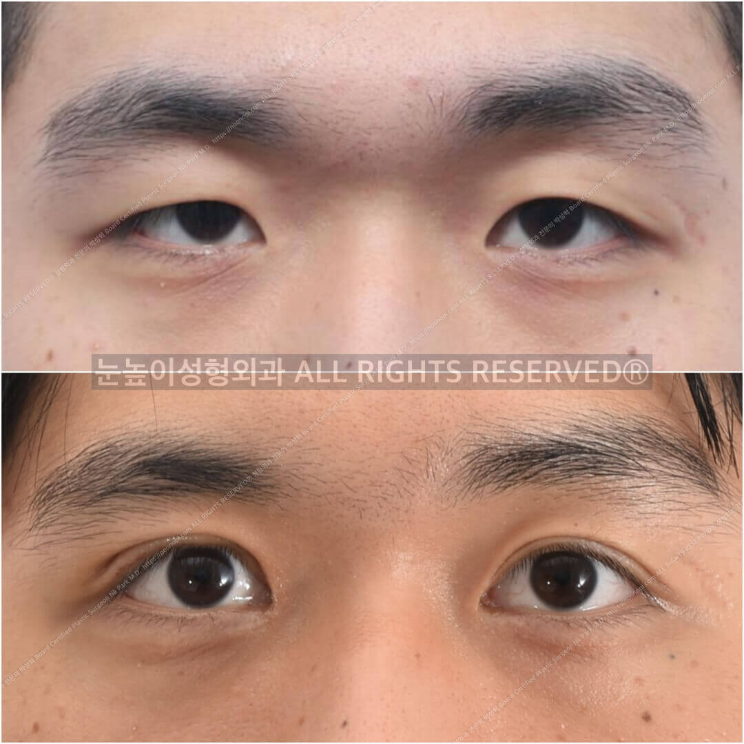 2 Secrets For Beautiful Eyes In Asian Double Eyelid Surgery » Noonopi Plastic Surgery Blog