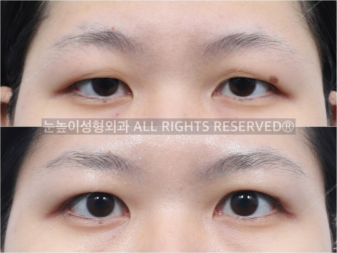 2 Secrets For Beautiful Eyes In Asian Double Eyelid Surgery » Noonopi ...