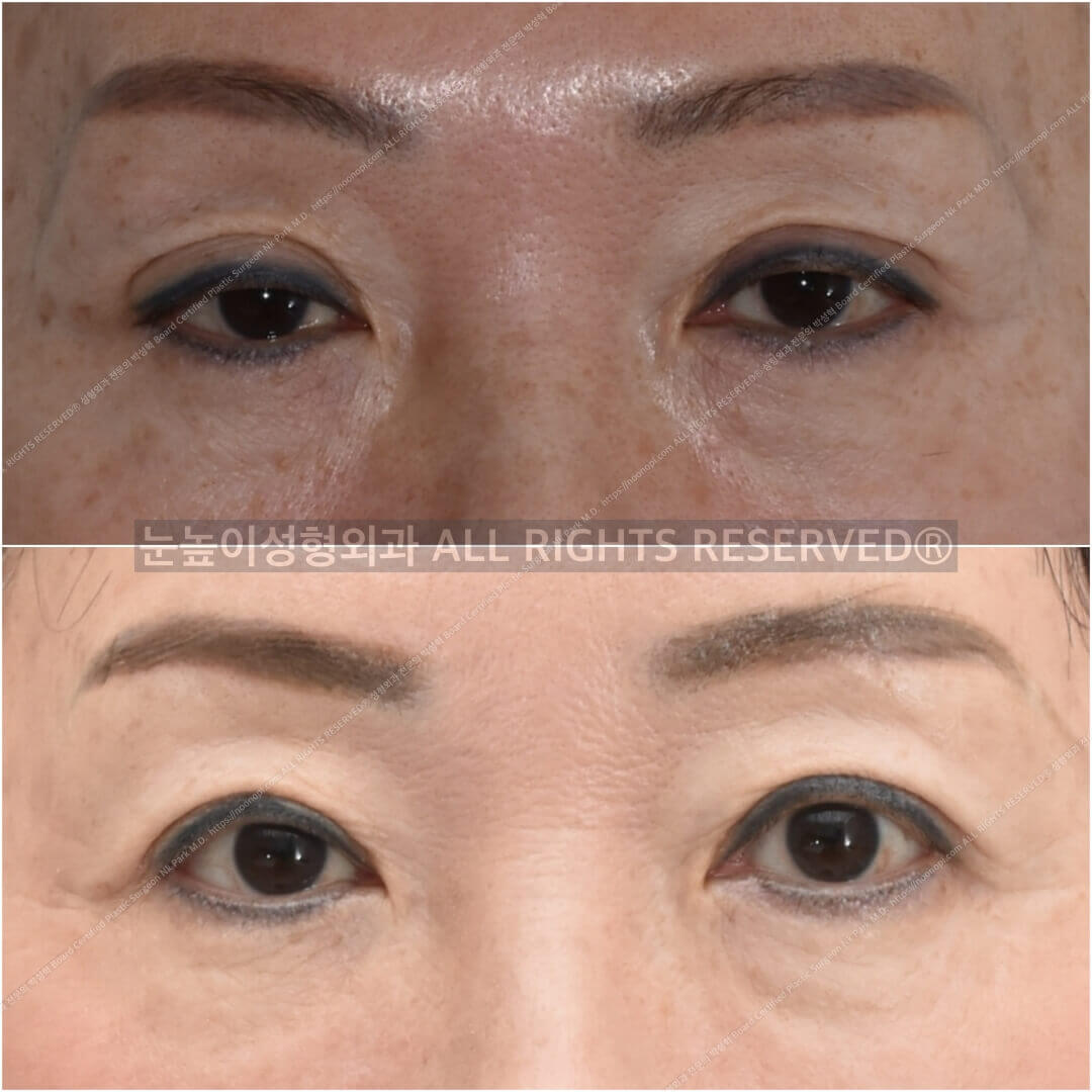 2 Secrets For Beautiful Eyes In Asian Double Eyelid Surgery » Noonopi Plastic Surgery Blog